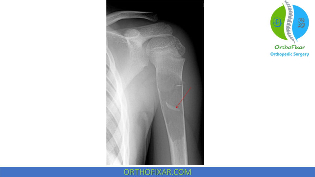 Simple Bone Cyst Fallen Fragment Sign