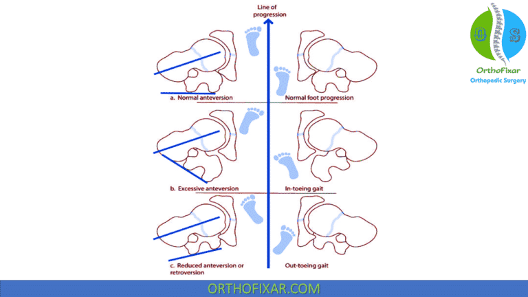Femoral Anteversion Angle Explained Easily | OrthoFixar