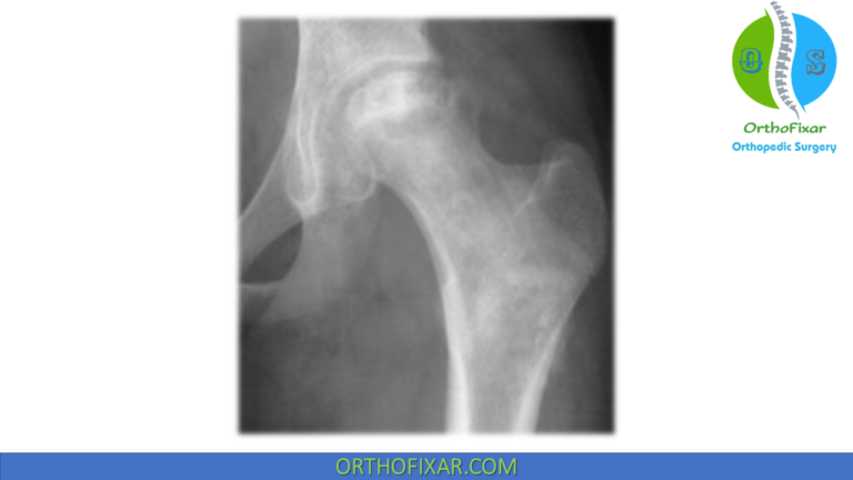 Osteonecrosis Of The Hip - Easy Explained | OrthoFixar 2025
