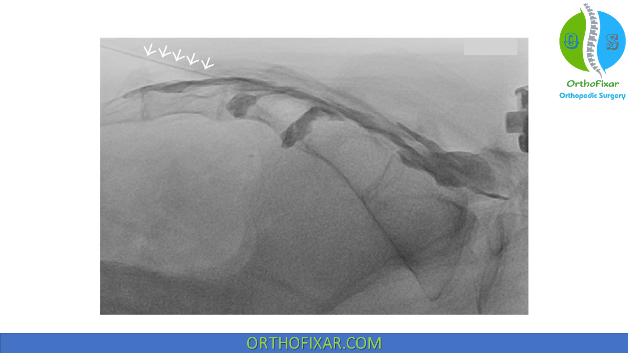 Caudal Epidural Injection Overview | OrthoFixar 2025