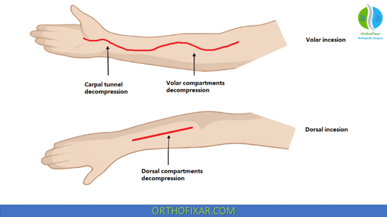 Forearm Fasciotomy Easily Step-By-Step | OrthoFixar