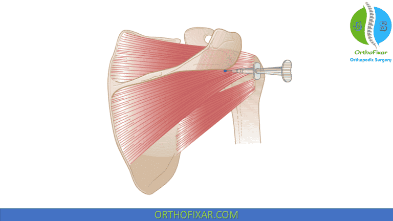 Frozen Shoulder Injection Easily Step-By-Step | OrthoFixar