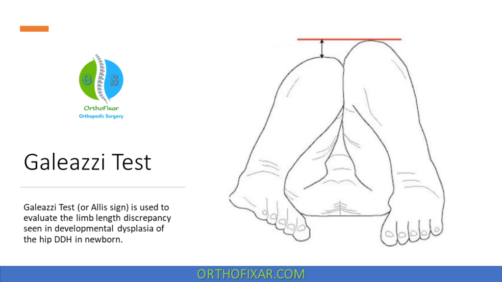 Galeazzi Test For Leg-Length Discrepancy Explained Easily | OrthoFixar