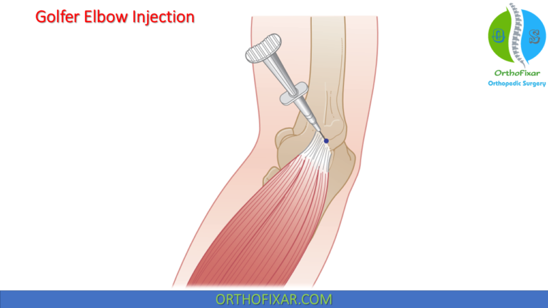 Tennis Elbow Injection Easily Step-By-Step | OrthoFixar