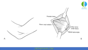 Golfer Elbow Surgery Easily Step-By-Step | OrthoFixar