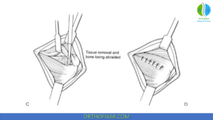 Golfer Elbow Surgery | OrthoFixar 2025