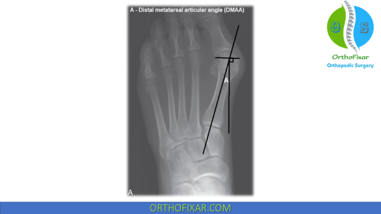 Adult Hallux Valgus - Easy Explained | OrthoFixar 2025