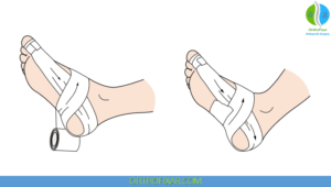 Hallux Valgus Taping Techniques | OrthoFixar 2025