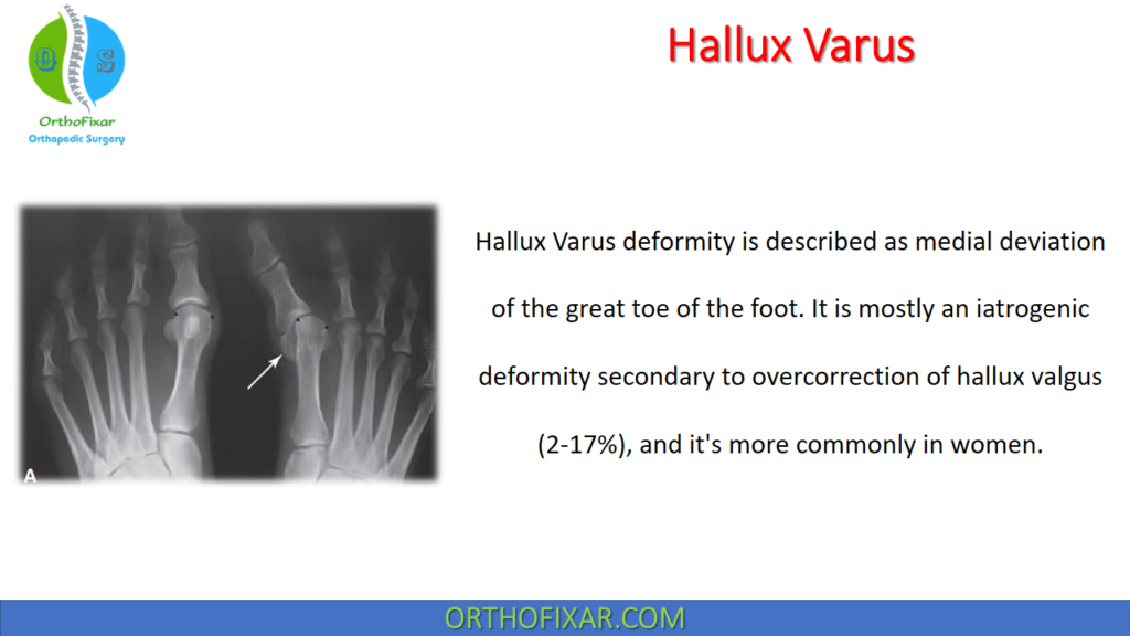 Hallux Varus - Easy Explained | OrthoFixar 2025