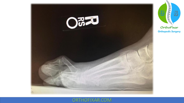 Hammer Toe Deformity
