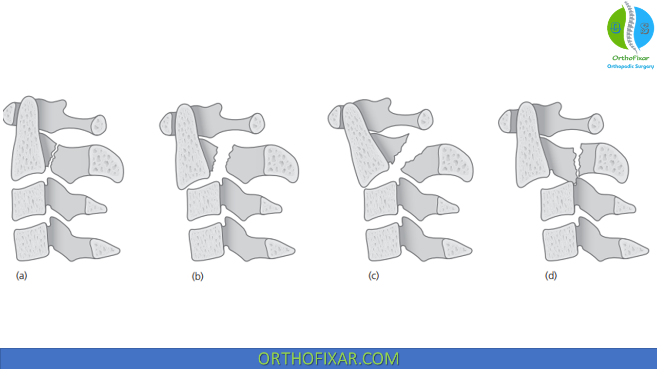 Hangman's Fracture
