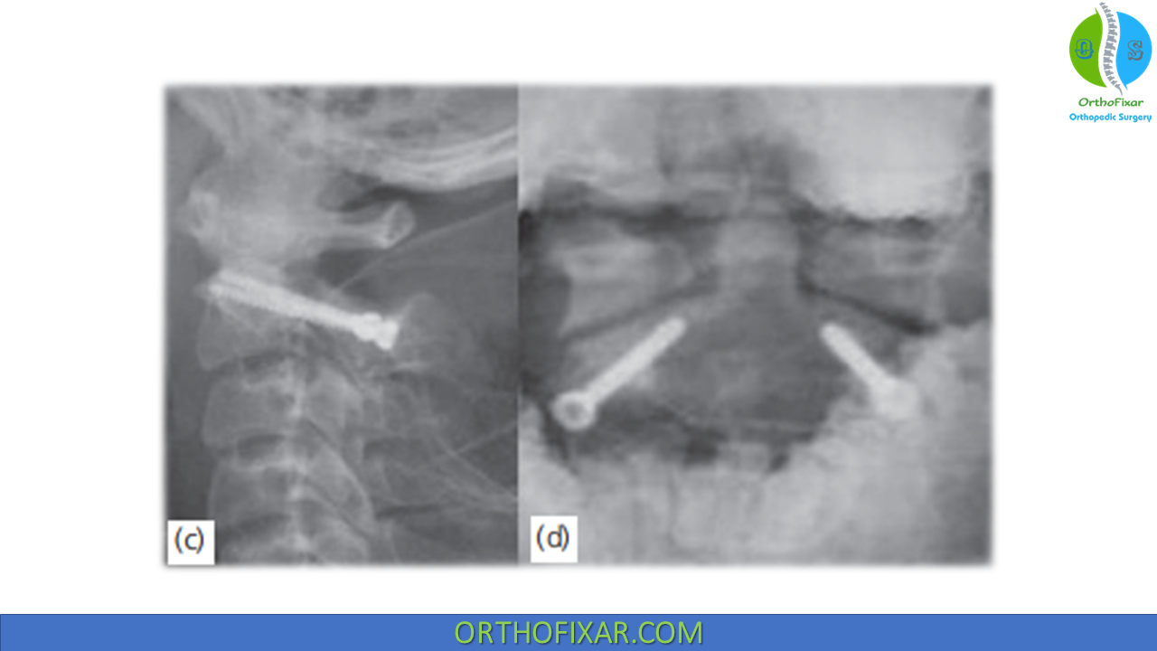 Hangman's Fracture | Orthopedic Learning