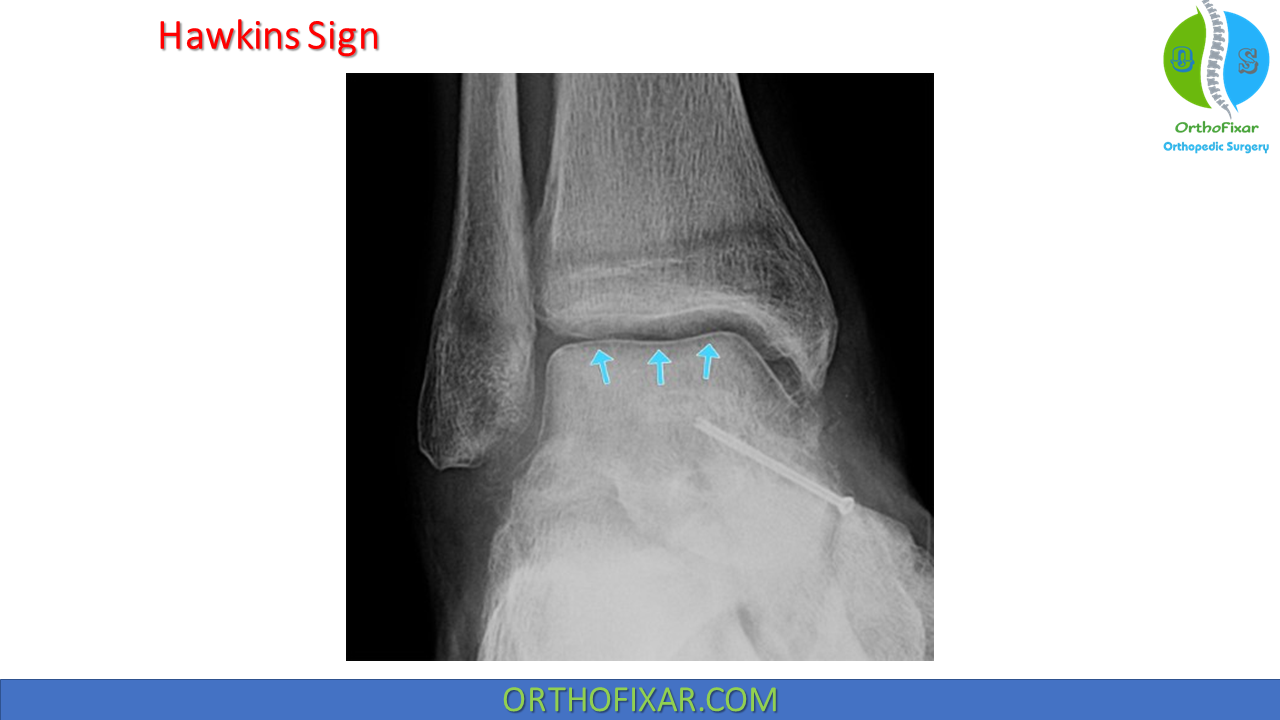 Talar Fractures & Dislocation | OrthoFixar 2025