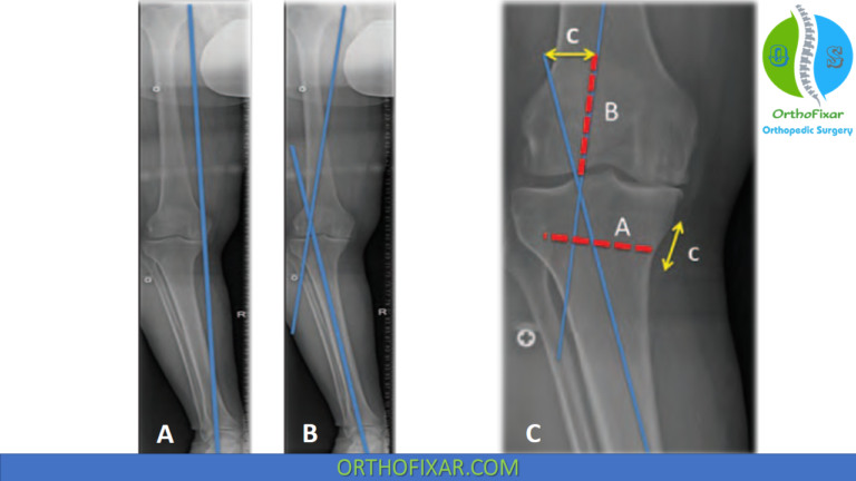High Tibial Osteotomy