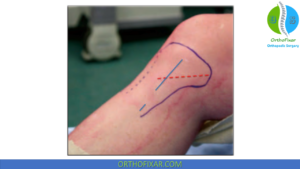 High Tibial Osteotomy Easily Step-By-Step | OrthoFixar