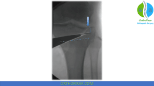 High Tibial Osteotomy Easily Step-By-Step | OrthoFixar