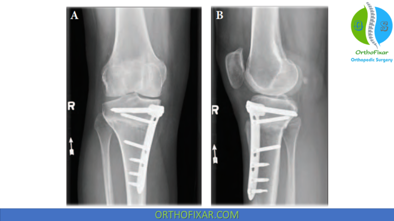 High Tibial Osteotomy
