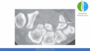 Hamate Fracture | OrthoFixar