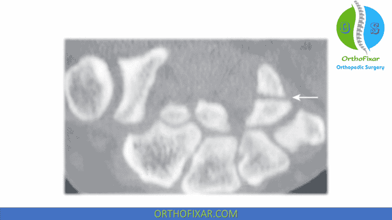Hamate Fracture | OrthoFixar