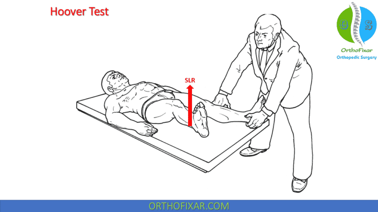 Hoover Test Explained Easily | OrthoFixar