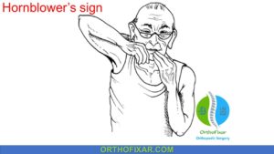 Hornblower Sign Explained Easily | OrthoFixar