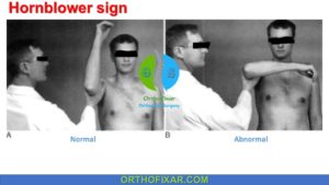 Hornblower Sign Explained Easily | OrthoFixar