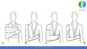 Humeral Shaft Fractures | OrthoFixar