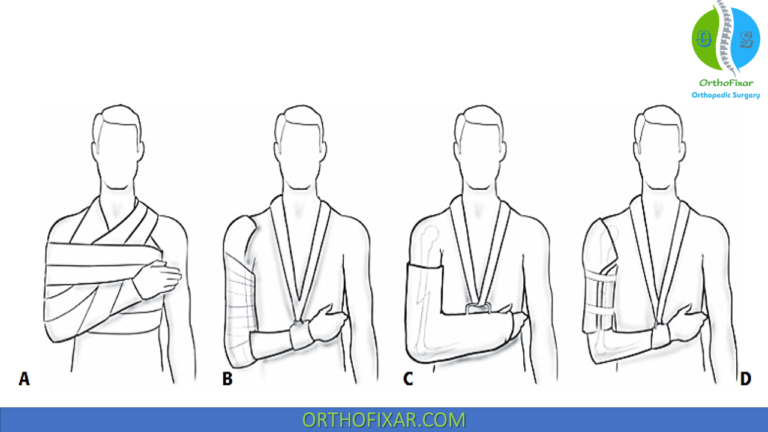 Humeral Shaft Fractures | OrthoFixar