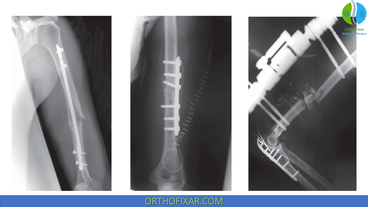 Humeral Shaft Fractures | OrthoFixar