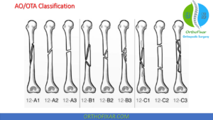 Humeral Shaft Fractures