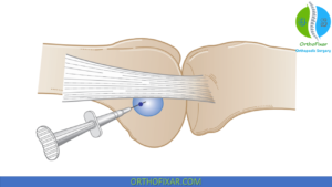 IT Band Injection Easy Explained | OrthoFixar 2026