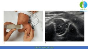 Infant Hip Ultrasound Explained Easily | OrthoFixar