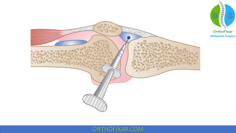 Infrapatellar Bursa Injection Easy Explain | OrthoFixar 2025