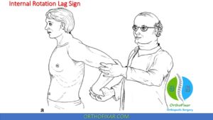 Internal Rotation Lag Sign Explained Easily | OrthoFixar