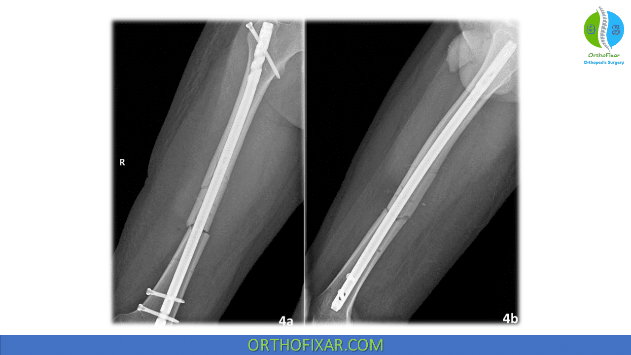 Intramedullary Femoral Nailing Easily Step-By-Step | OrthoFixar