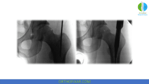 Intramedullary Femoral Nailing Easily Step-By-Step | OrthoFixar