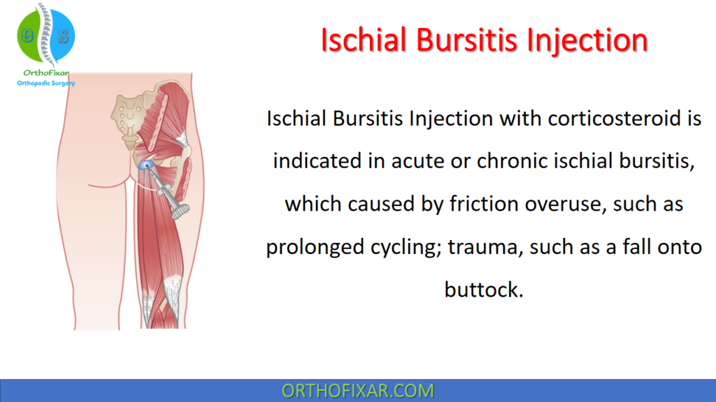Ischial Bursitis Injection - Easy Tutorial | OrthoFixar 2025