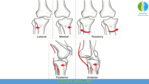 Knee Dislocation | Diagnosis & Treatment | OrthoFixar