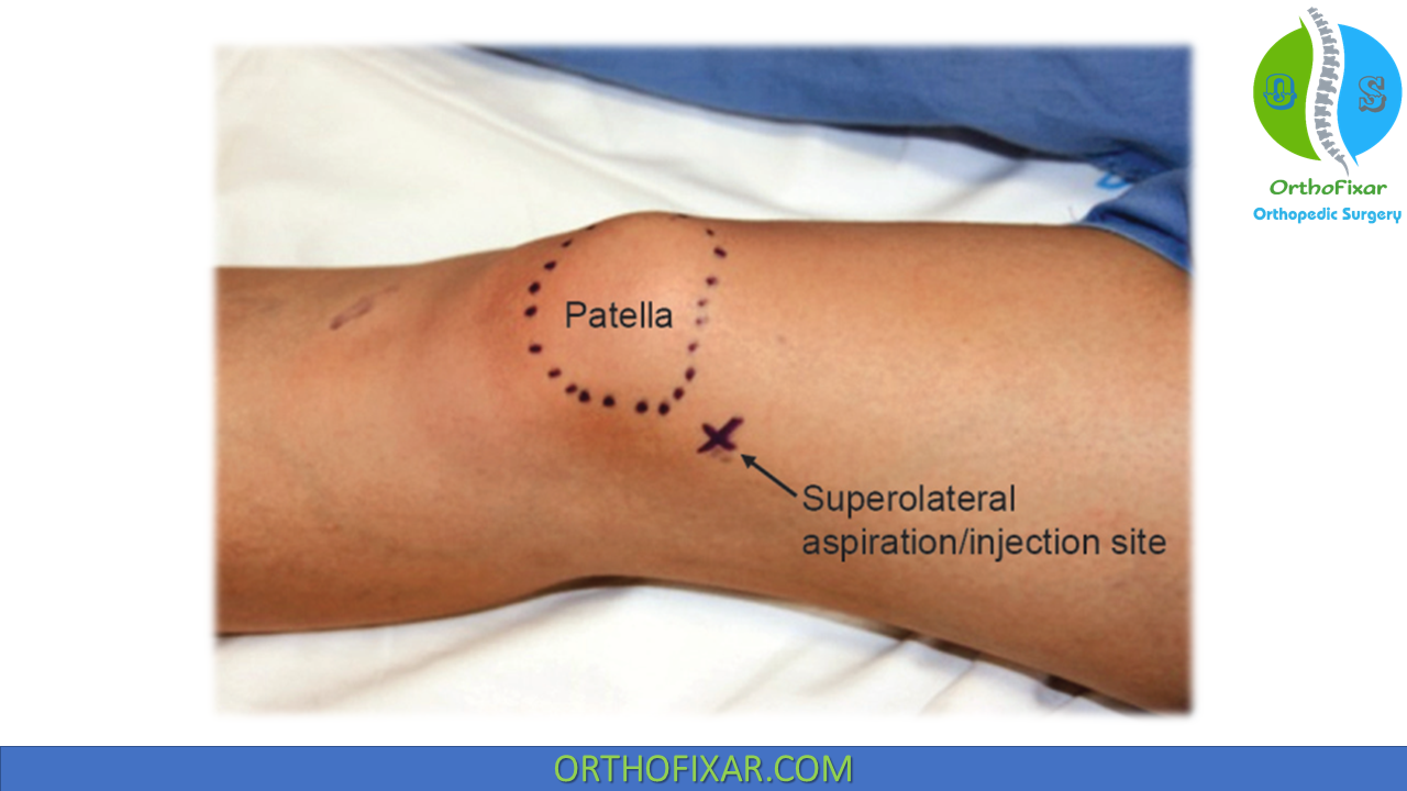 Knee Injection Technique - Easy Tutorial | OrthoFixar 2025