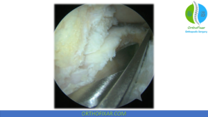 Knee Meniscal Transplantation