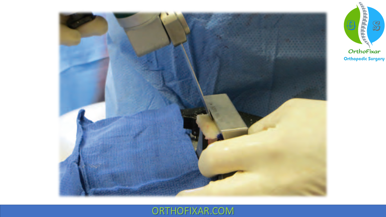 Knee Meniscal Transplantation