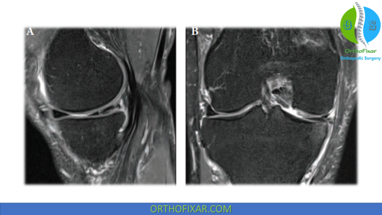 Knee Meniscus Tear Surgery | OrthoFixar 2025