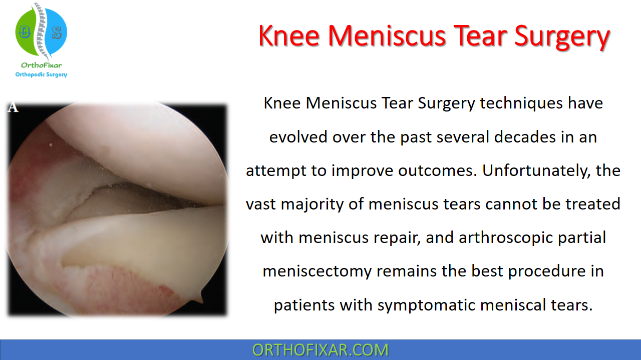Pain Under Knee Cap After Meniscus Surgery At Sue Alexander Blog