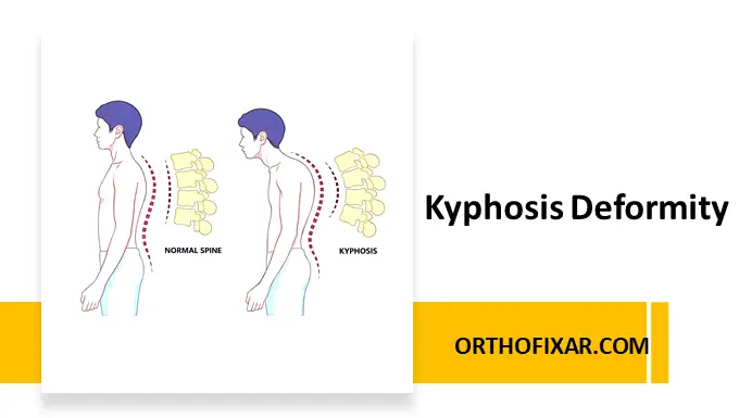 Kyphosis Deformity Meaning, Causes & Treatment | Orthopedic Learning