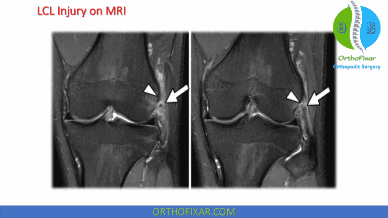 Knee LCL Sprain | OrthoFixar