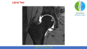 Femoroacetabular Impingement (FAI) | OrthoFixar