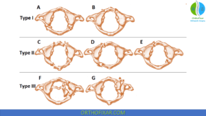 Atlas Fracture Overview | Orthopedic Learning