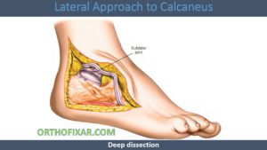 Lateral Approach To Calcaneus • Full Tutorial 2025 • OrthoFixar
