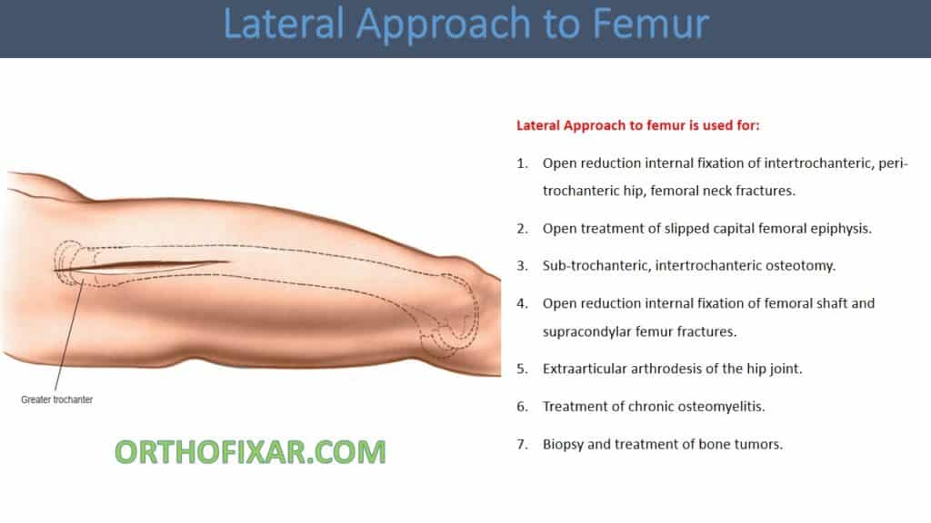 Approaches Category: Femur Approaches | OrthoFixar