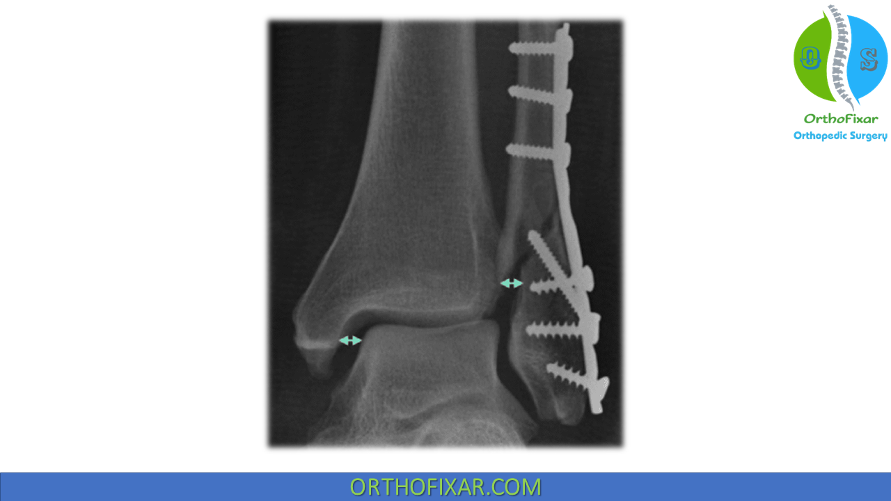 Lateral Malleolus Fracture Treatment Easily Step-By-Step | OrthoFixar